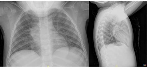 Revista De Pediatría De Atención Primaria Alloiococcus Otitidis ¿patógeno Exclusivo Del Oído