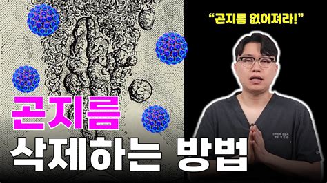 성병 곤지름 그렇게 간단하지 않을 수 있어요 [ Hpv 바이러스 인유두종바이러스 성기 사마귀 콘딜로마 산부인과