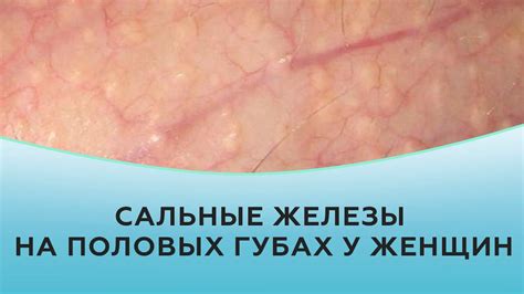 Сальные железы на половых губах у женщин Youtube