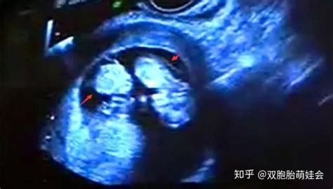 连载八 圆圈妈双胞胎怀孕过程第11周 知乎