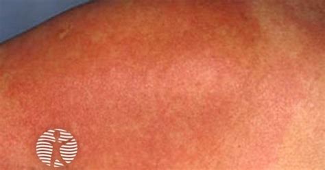 Erythema Migrans Image