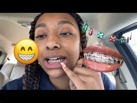 Getting Braces Vlog Part Youtube