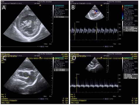 심장 중재술을 이용한 개의 근성 심실중격결손증의 치료 증례 네이버 블로그