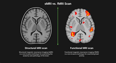 Autism Brain Diagram