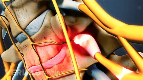 Cervical Selective Nerve Root Block Video