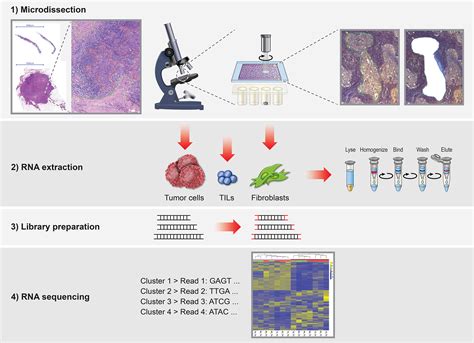 Clonal Expansion Of Intra‐epithelial T Cells In Breast Cancer Revealed