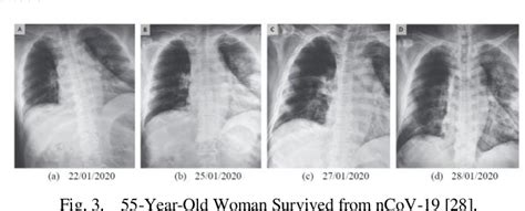 Figure 1 From Detection Of Ncov 19 From Hybrid Dataset Of Cxr Images Using Deep Convolutional