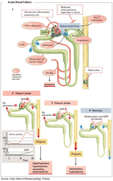 Understanding Acute Renal Failure Causes Symptoms And Treatment