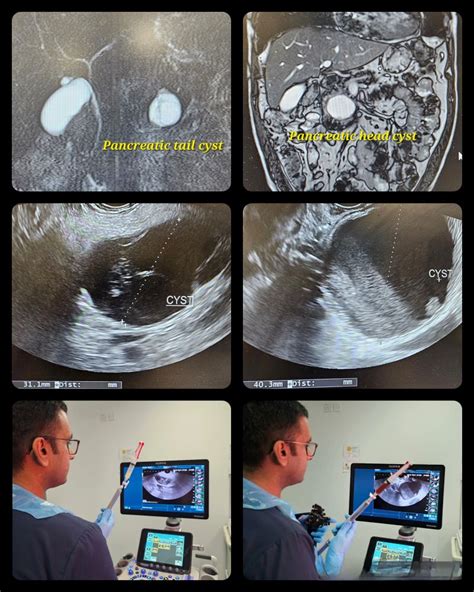 Faisal Nawaz On Linkedin Endoscopic Ultrasound Eus Guided Fna Performed On Two Patients One…