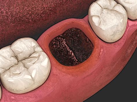 Wisdom Tooth Extraction Hole