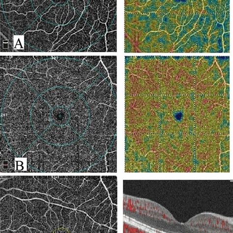 Optical Coherence Tomography Angiography Image Of A Normal Subject A Download Scientific