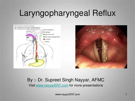 Symptoms Of Lpr Reflux A Lump In The Throat Laryngopharyngeal Reflux