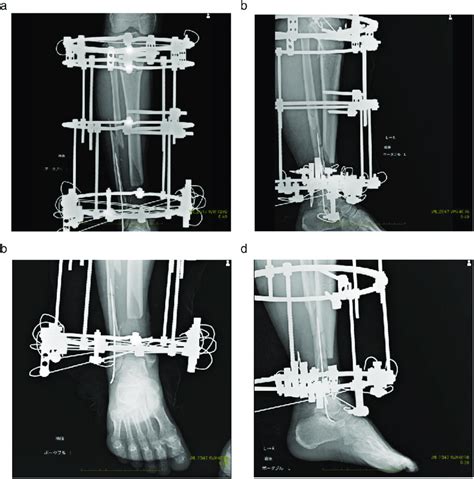 A Ap B Lateral C Ap D Lateral The X Ray After Proximal Tibia Download Scientific Diagram