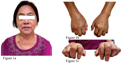 Dermatomyositis Paraneoplastic Syndrome