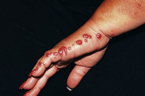 Arthropod Bites Bug Bites Insect Bites Anesthesia Key