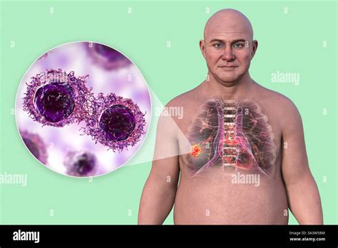 Immagine Delluomo Con Cancro Ai Polmoni Che Mostra La Posizione E L