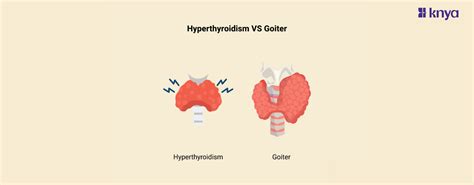 Difference Between Hyperthyroidism And Goiter Explained Knya