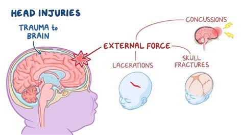 Contusion Cerebral Anisocoria Without Extraocular Muscle Impairment
