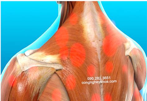 Trigger Point Là Gì Công Nghệ Y Khoa Mdt