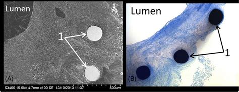 Vessel Lumen Upper Left And Vascular Wall Containing The Stent Struts