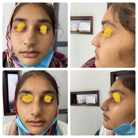 Nasal Surgery Sarb Hospital