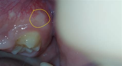 White Spot On Upper Gums Raskdentists
