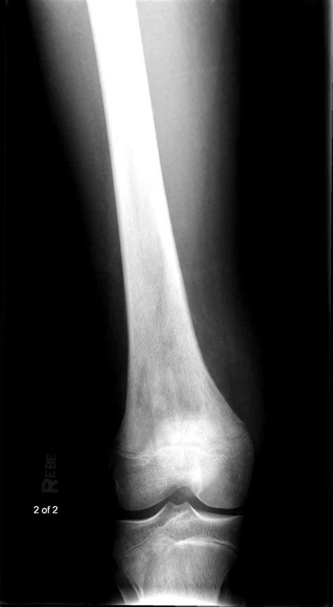 Osteosarcoma X Ray Codmans Triangle