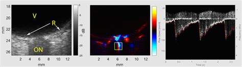 Plane Wave Vol 3 Issue 2 Verasonics Provides Outstanding Research Ultrasound Capabilities