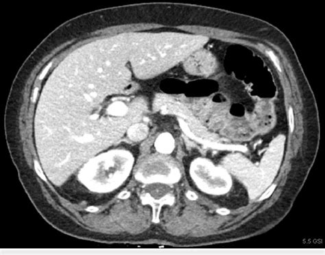 Spiral Abdomen And Pelvic Ct Showing Complete Resolution Of The