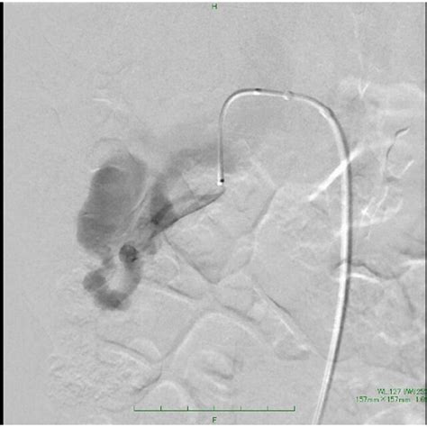 Arterial Angiography Before Tae Dilated Inflow And Outflow Vessels Download Scientific Diagram
