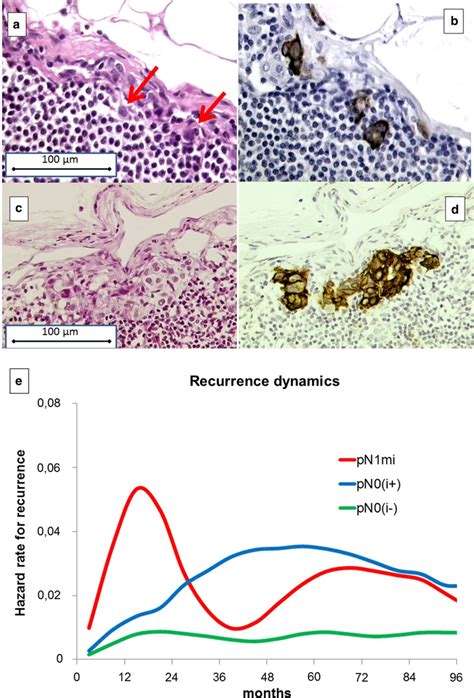 Pathological Illustrations Of Lymph Node Occult Metastases And The Download Scientific Diagram