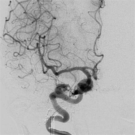 Cerebral Angiography During The Embolization Procedure Using Download Scientific Diagram