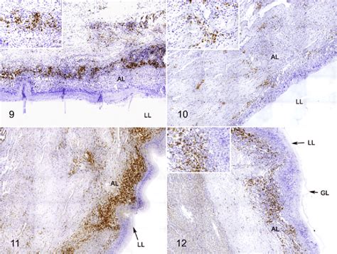 Cystic Echinococcosis Lung Cattle Immunohistochemistry For Cd20þ B