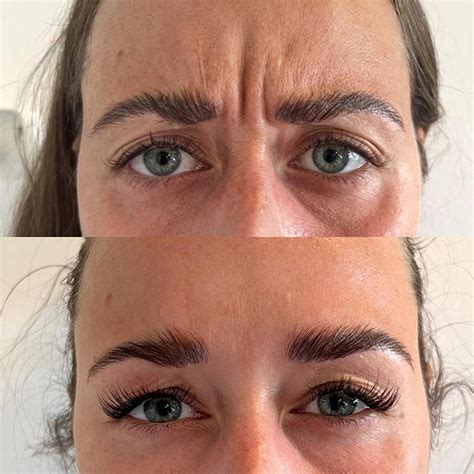 Alt Godt Om Botox Maria Bobjerg Den Kosmetiske Klinik