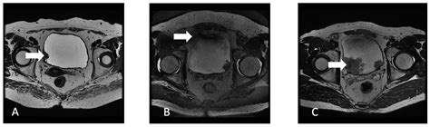 Msedtnet Multi Scale Encoder And Decoder With Transformer For Bladder Tumor Segmentation