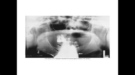 Panoramic Positioning Errors Slide Test Flashcards Quizlet