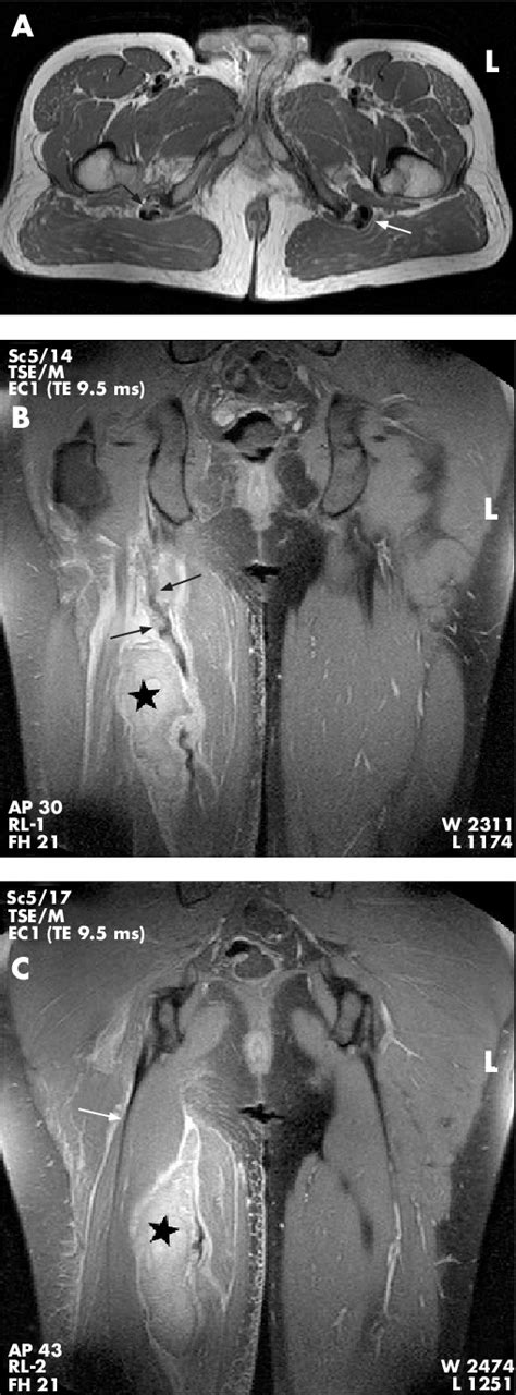 Magnetic Resonance Images Of A Patient With A Partial Proximal Download Scientific Diagram
