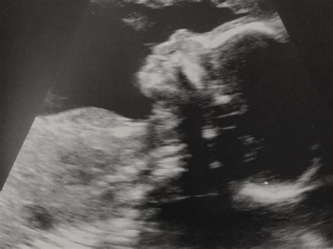 What Is An Anatomy Ultrasound During Pregnancy