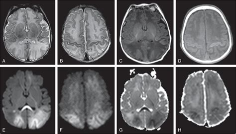 Hypoxic Ischemic Injury And Cerebrovascular Disorders Clinical Tree