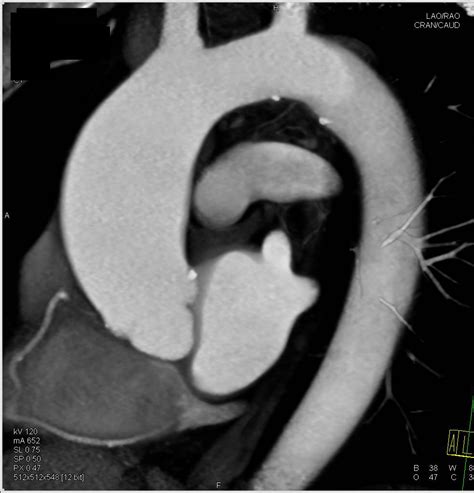 Dilated Ascending Aorta With 3d Mapping Vascular Radiology Case