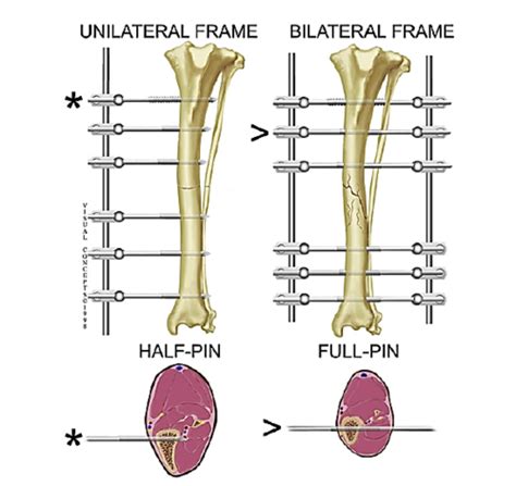 External Skeletal Fixation Flashcards Quizlet
