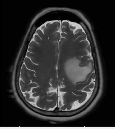 Figure 3 From A Rare Case Of Duodenal Adenocarcinoma With Brain Metastasis Semantic Scholar