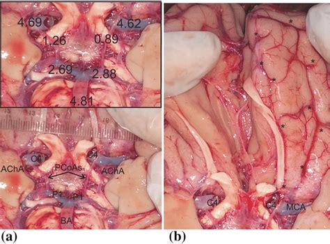 Case Of Bilateral Aplasia Of The Anterior Cerebral Artery Aca View Download Scientific