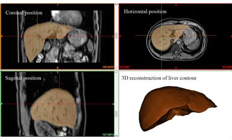 A 3d Quantification Technique For Liver Fat Fraction Distribution Analysis Using Dixon Magnetic