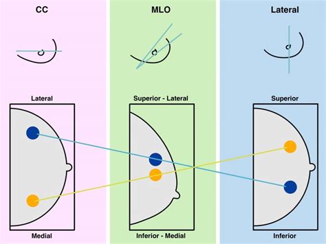 Breast Lesion Localization Radiology Ucla Health