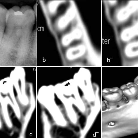 Periapical Radiograph And Different Ct Views Of Buccal Bone Defect Download Scientific Diagram