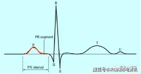 正常心电图波形及临床意义 心室