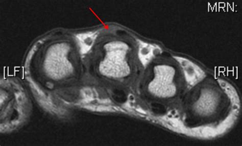 Sagittal Band Rupture Hand Orthobullets