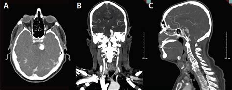 Acute Basilar Artery Thrombosis Mapasgmaes
