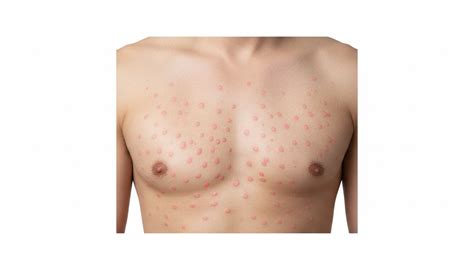 Hiv Rash On Chest Look Like